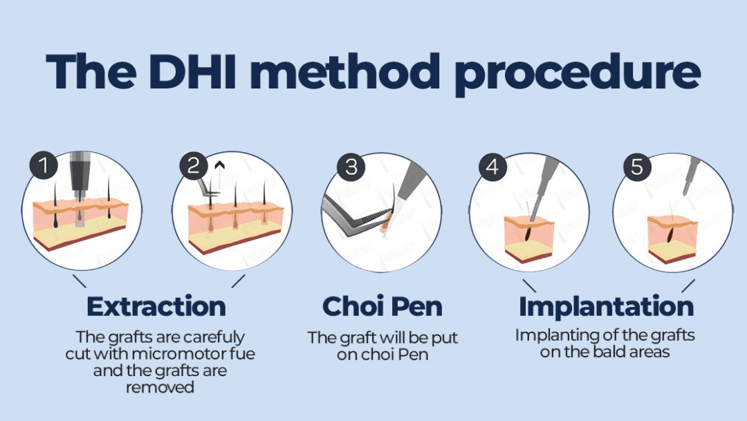 DHI Hair Transplant – Arges Clinic